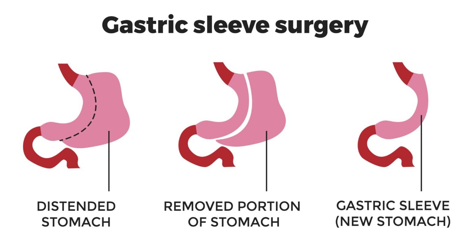 Gastric Sleeve Surgery in Turkey - Uncalı Hospital